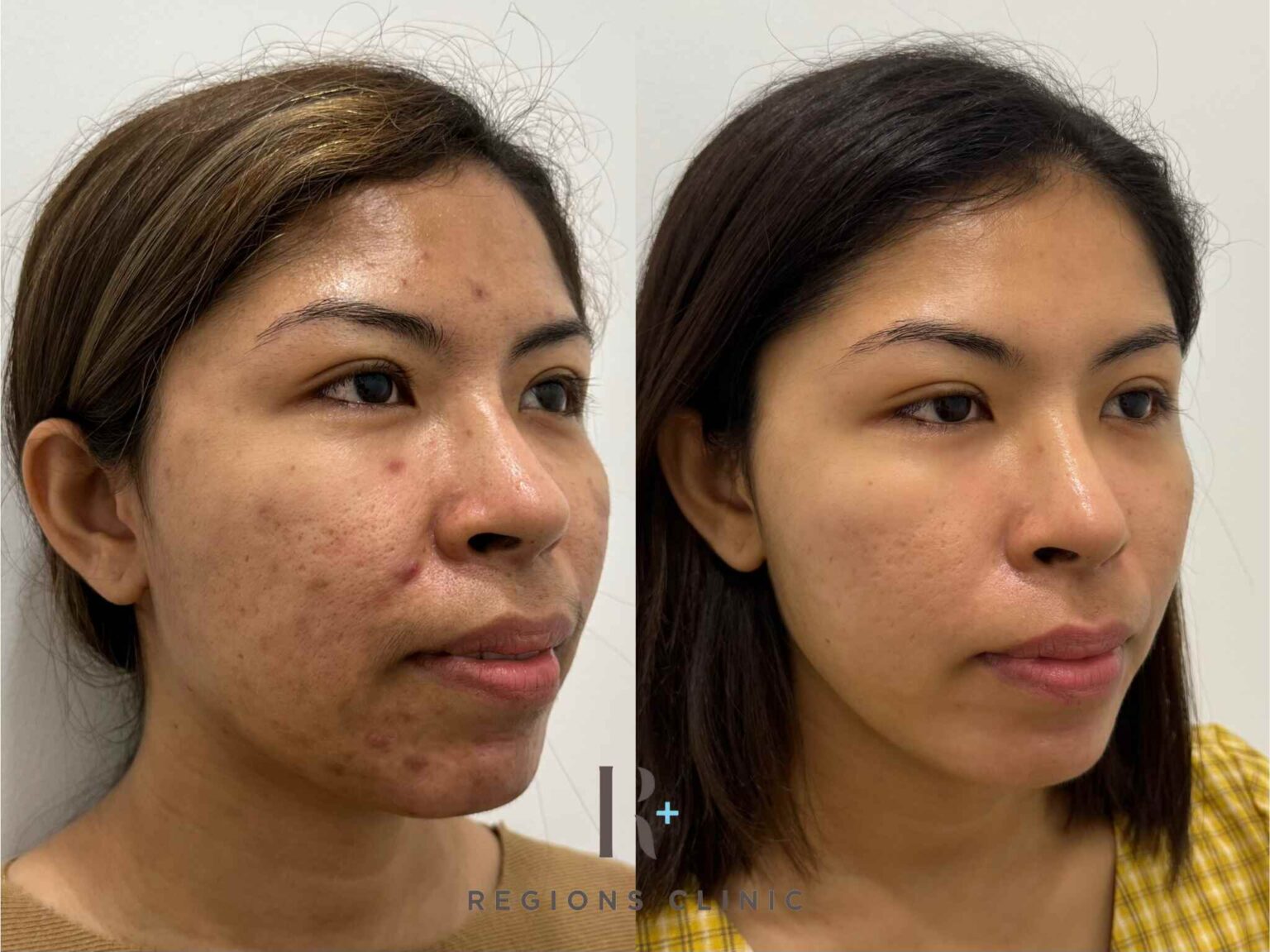8 Types of Best Facial Treatments in Malaysia | Facial in KL
