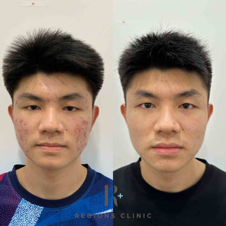 8 Types of Best Facial Treatments in Malaysia | Facial in KL