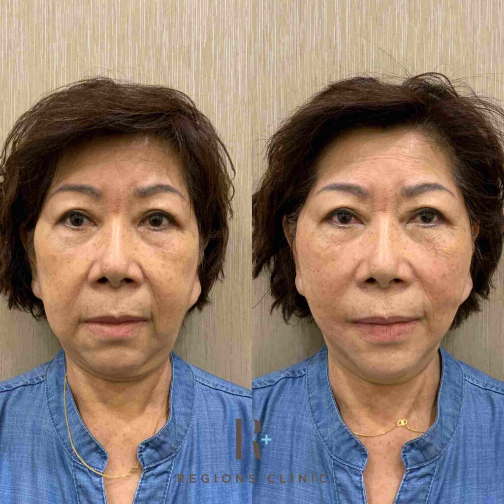 Aesthetic Before & After Photos Malaysia | Regions Clinic KL