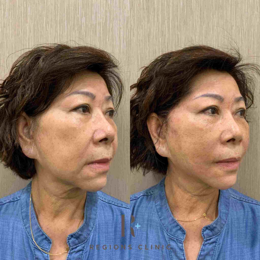 Aesthetic Before & After Photos Malaysia | Regions Clinic KL