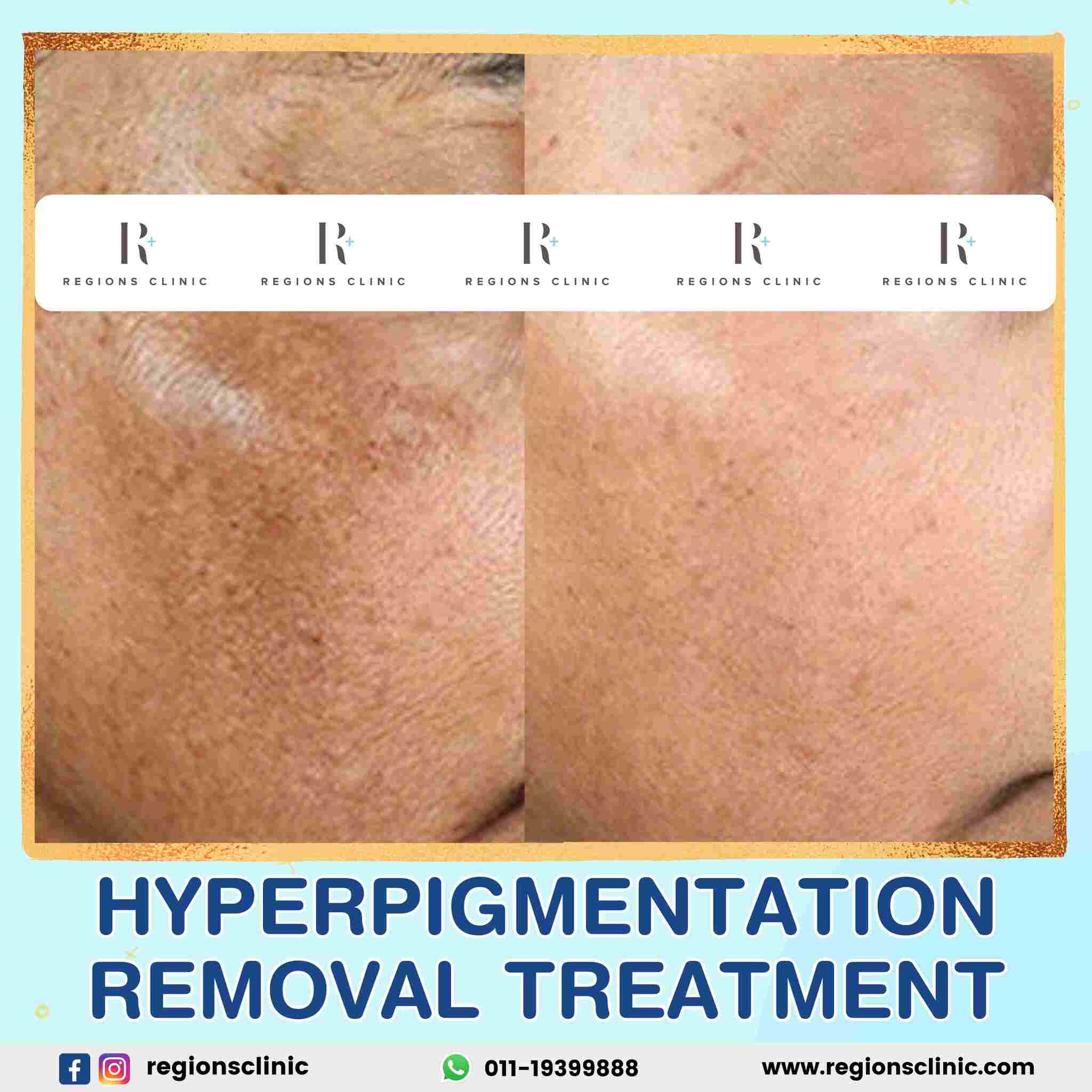 6 Best Hyperpigmentation Treatments in Malaysia | Pico Laser