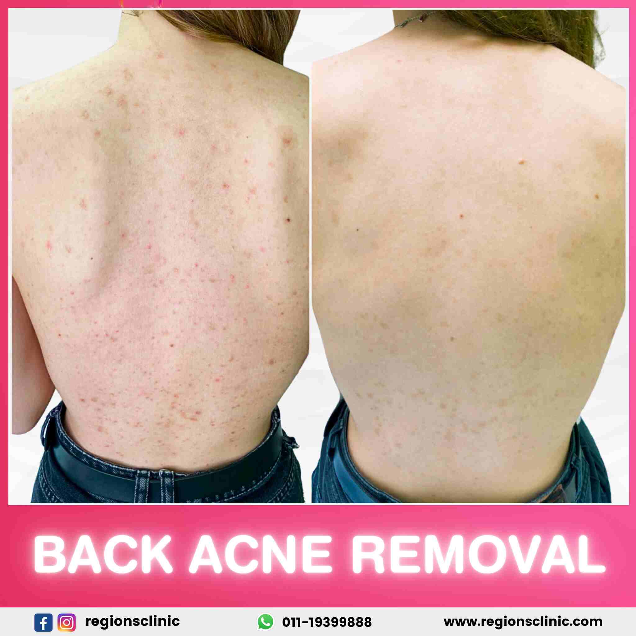 Best Relief & Confidence Today with Bacne Treatment Malaysia